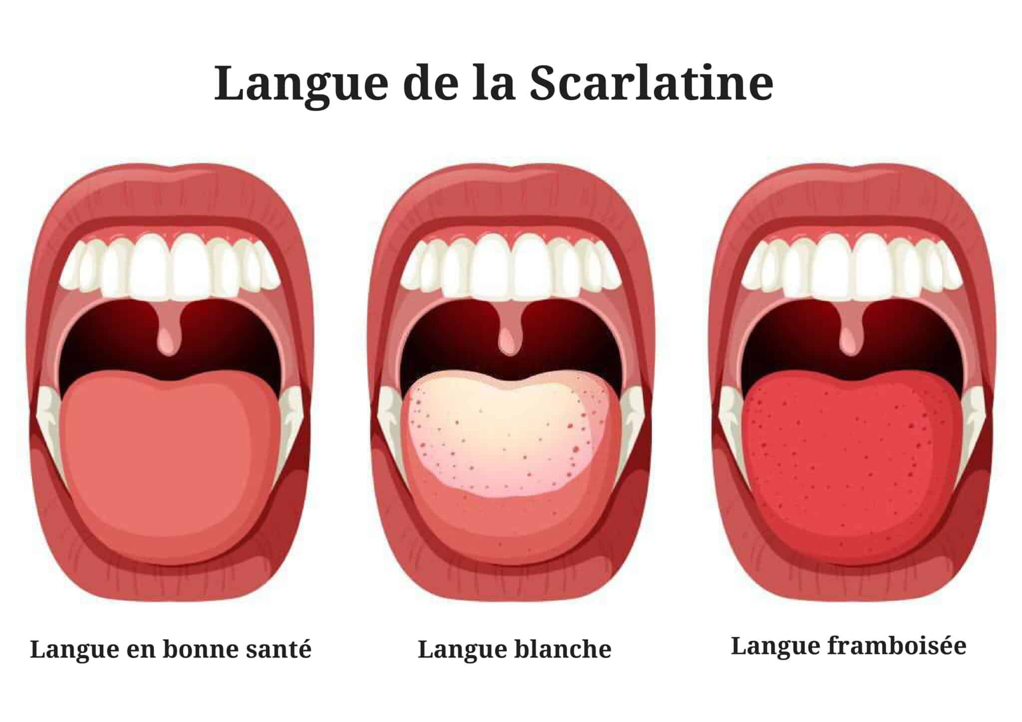 Au-Delà de l'Angine : Tout Savoir sur la Scarlatine et Ses Risques